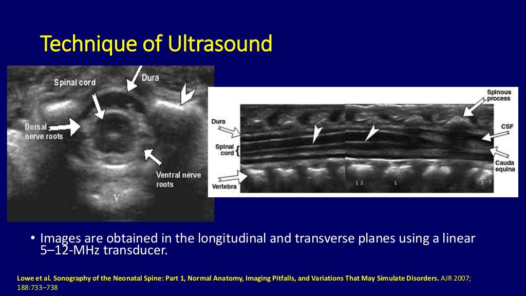 Baby Boy Spine Ultrasound at David Daigle blog