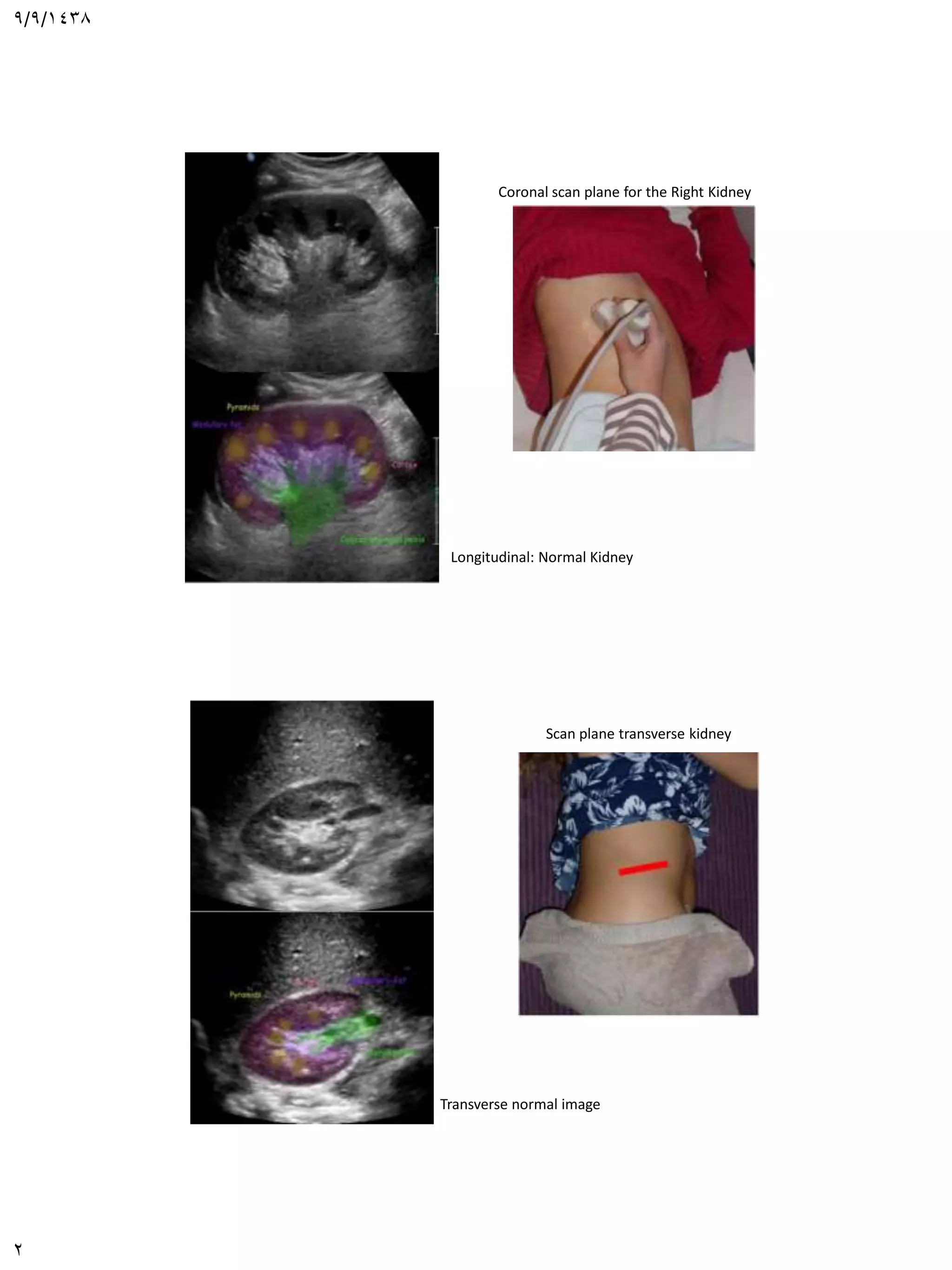 Ultrasound of the adult kidney | PDF