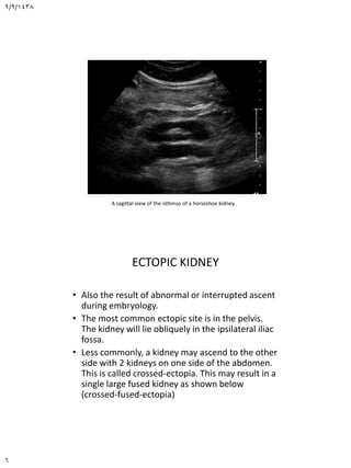 Kidney Ultrasound Images Abnormal