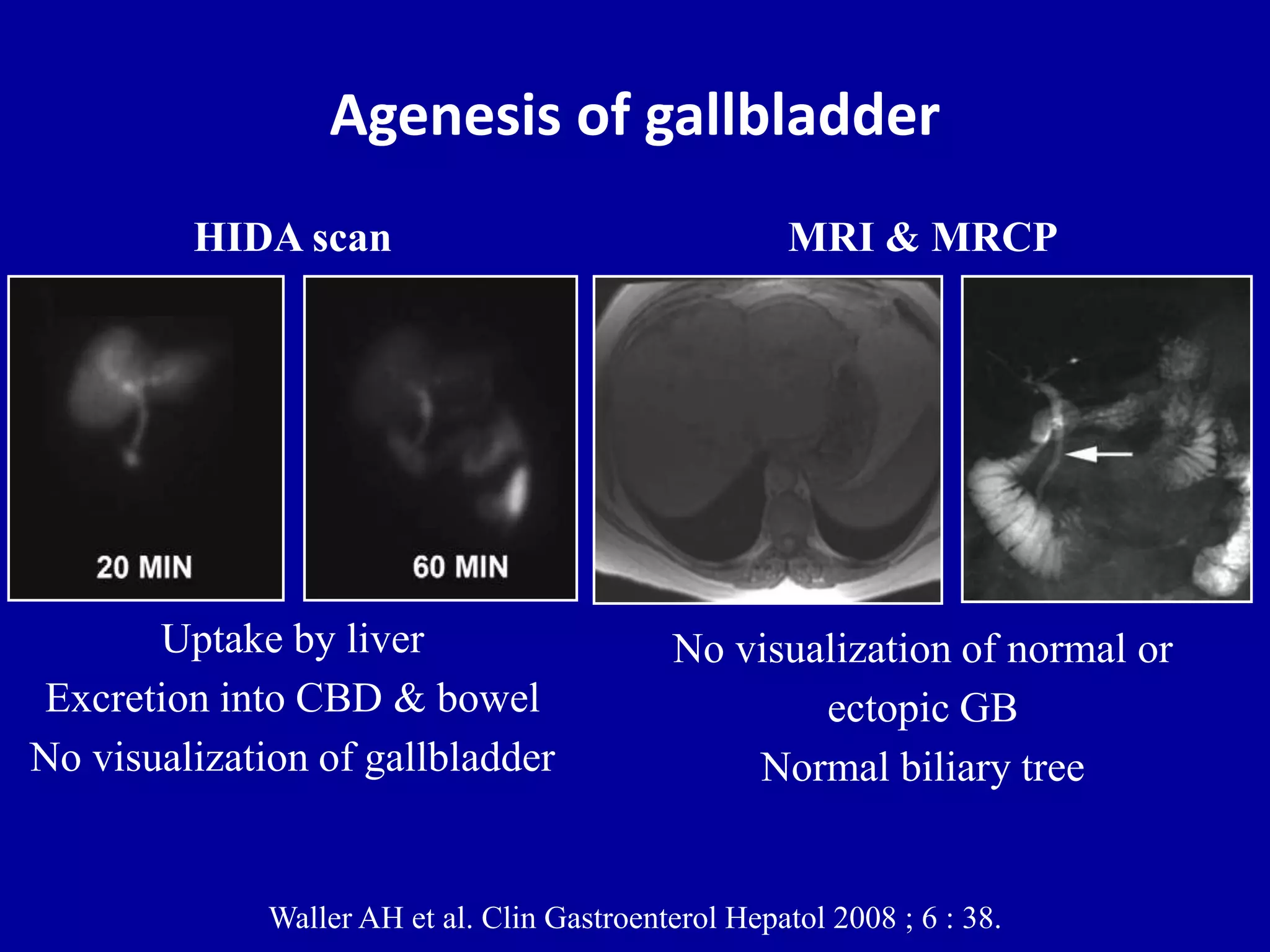Ultrasound of the gallbladder | PPTX