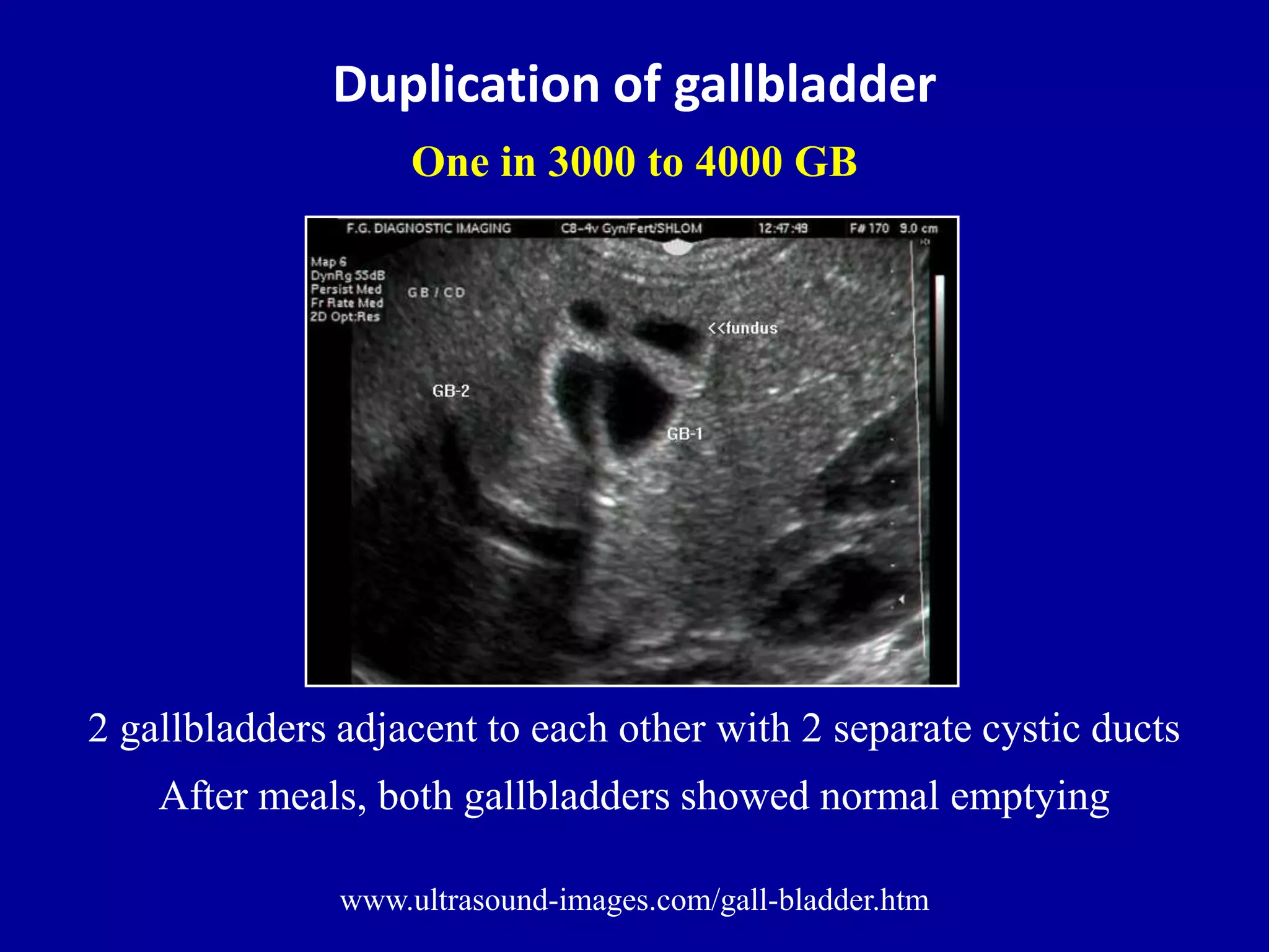 Ultrasound of the gallbladder | PPTX