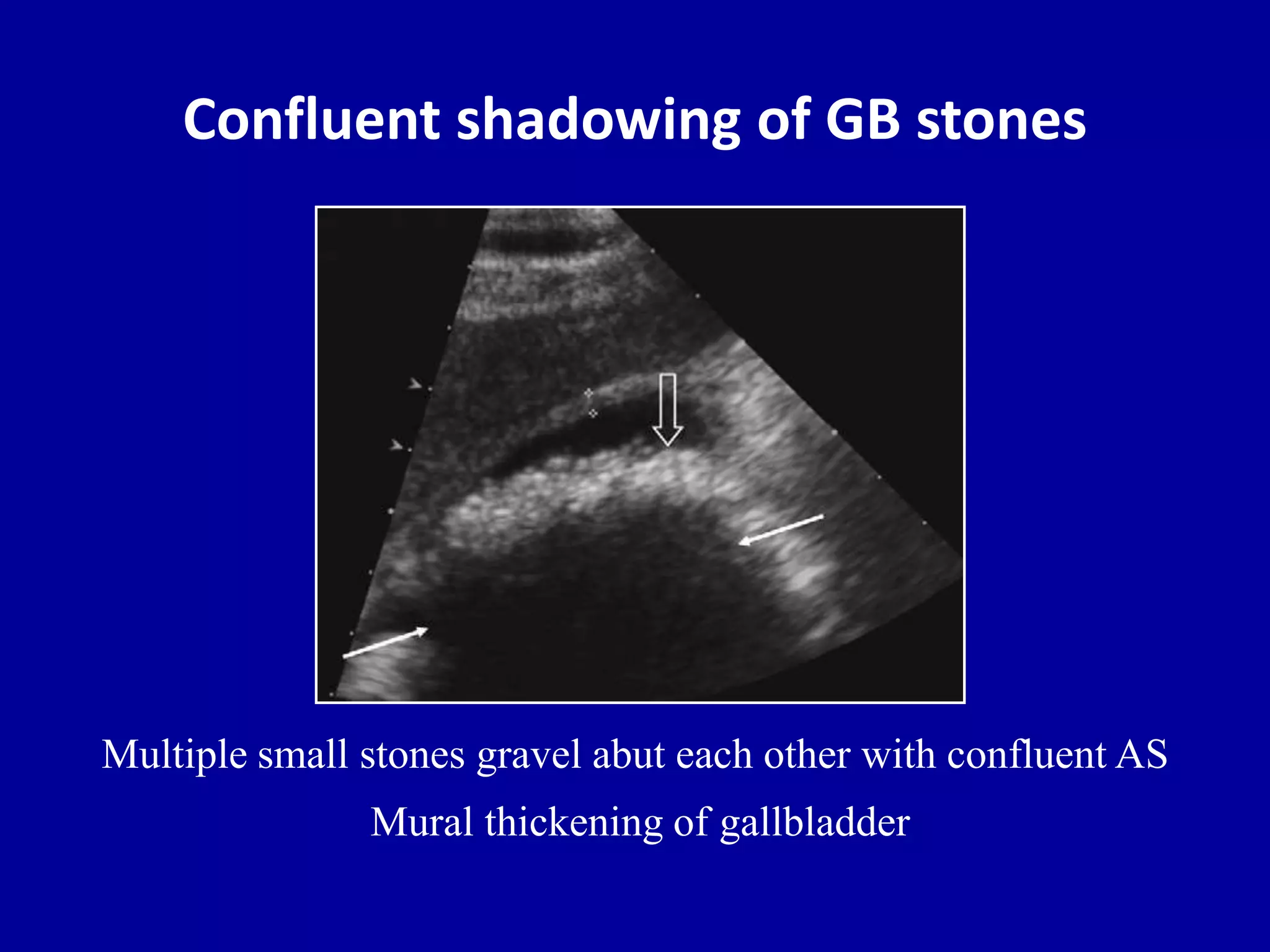 Ultrasound of the gallbladder | PPTX