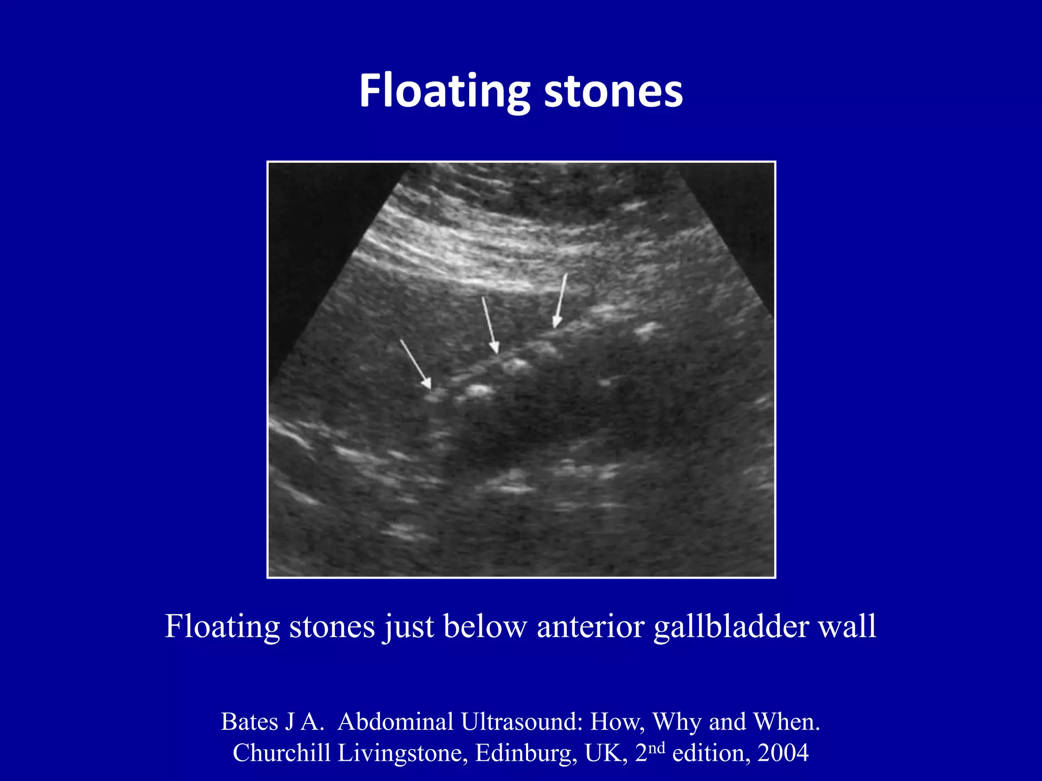 Ultrasound of the gallbladder | PPTX