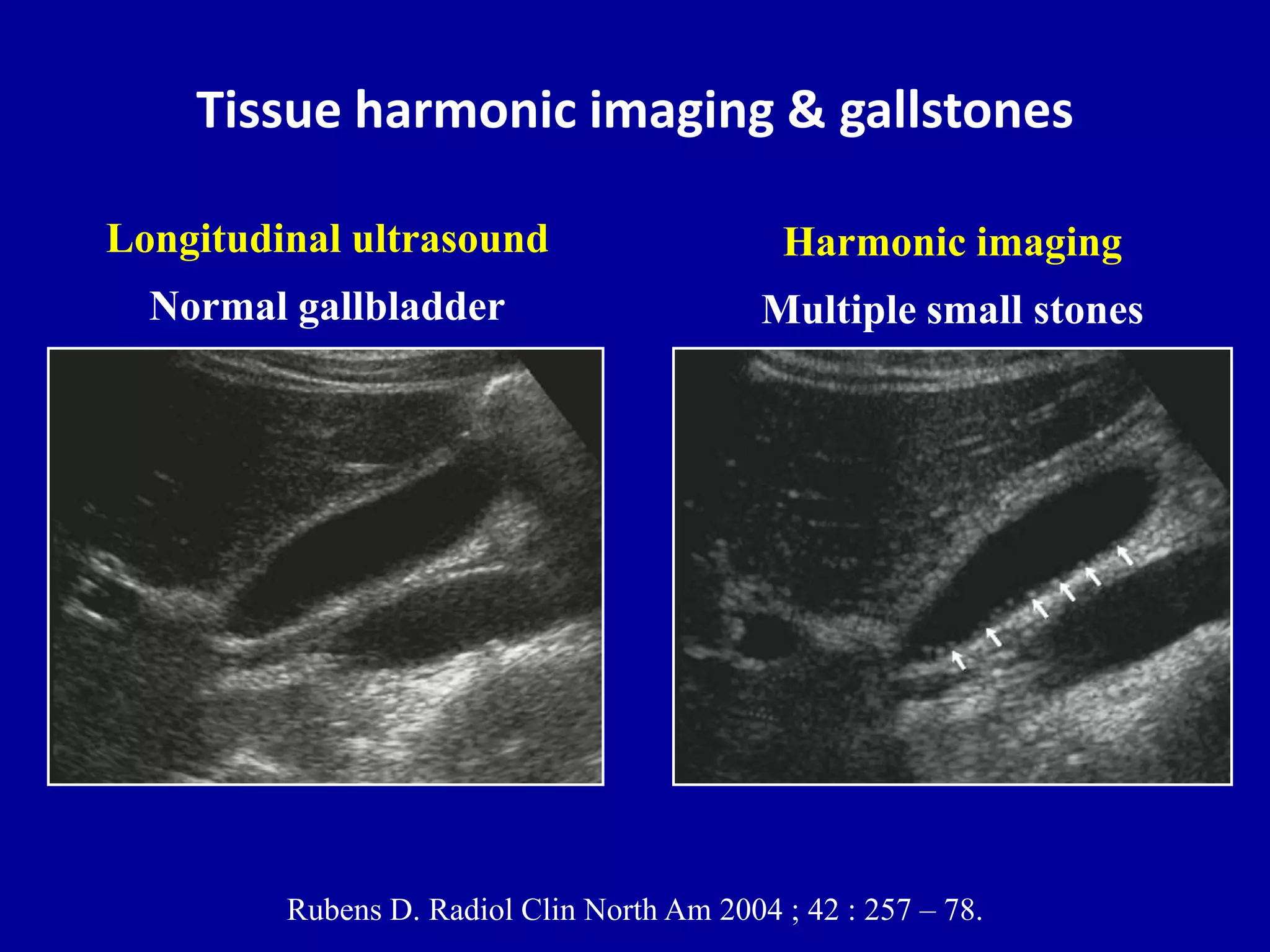 Ultrasound of the gallbladder | PPTX