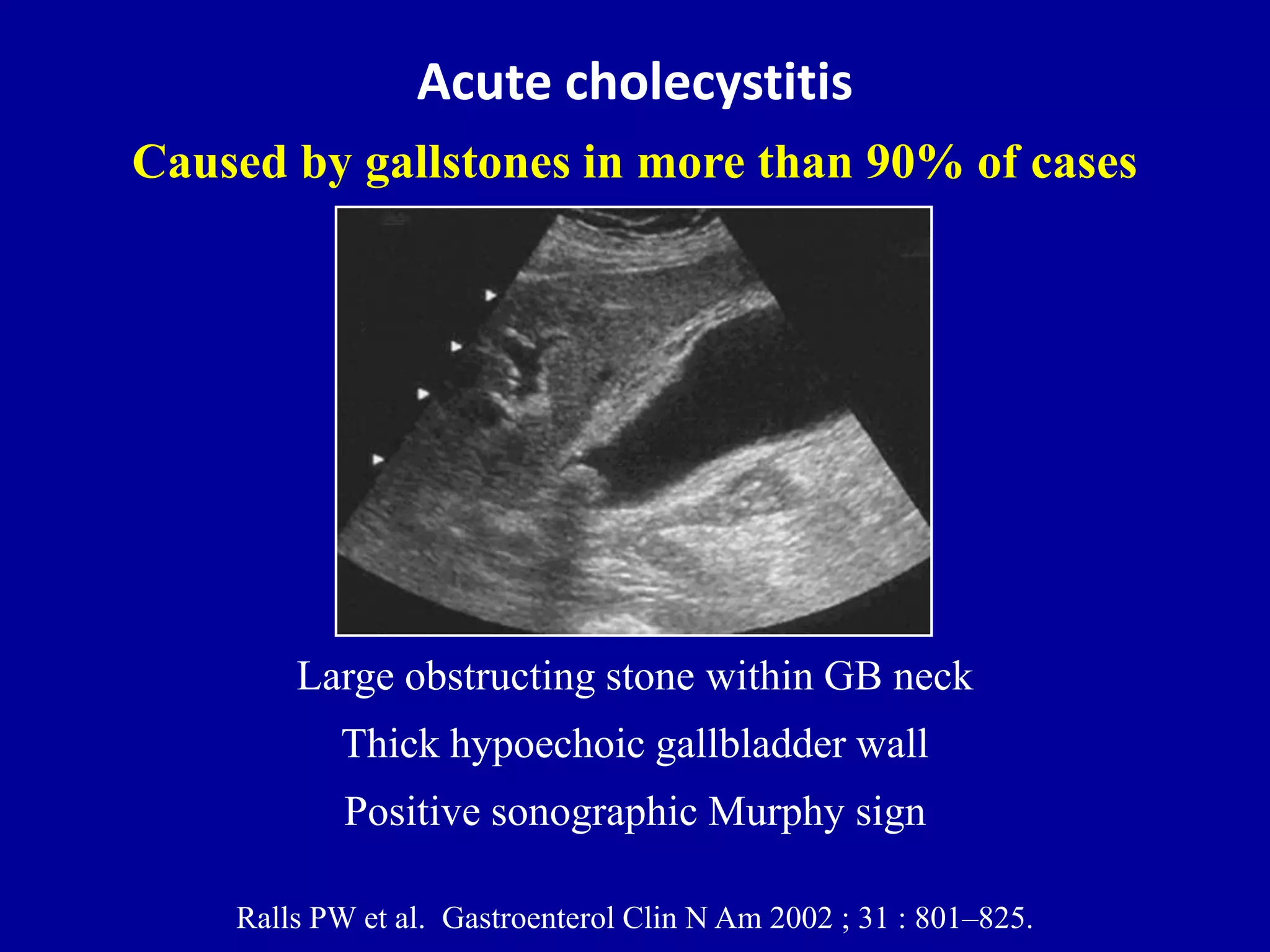 Ultrasound of the gallbladder | PPTX