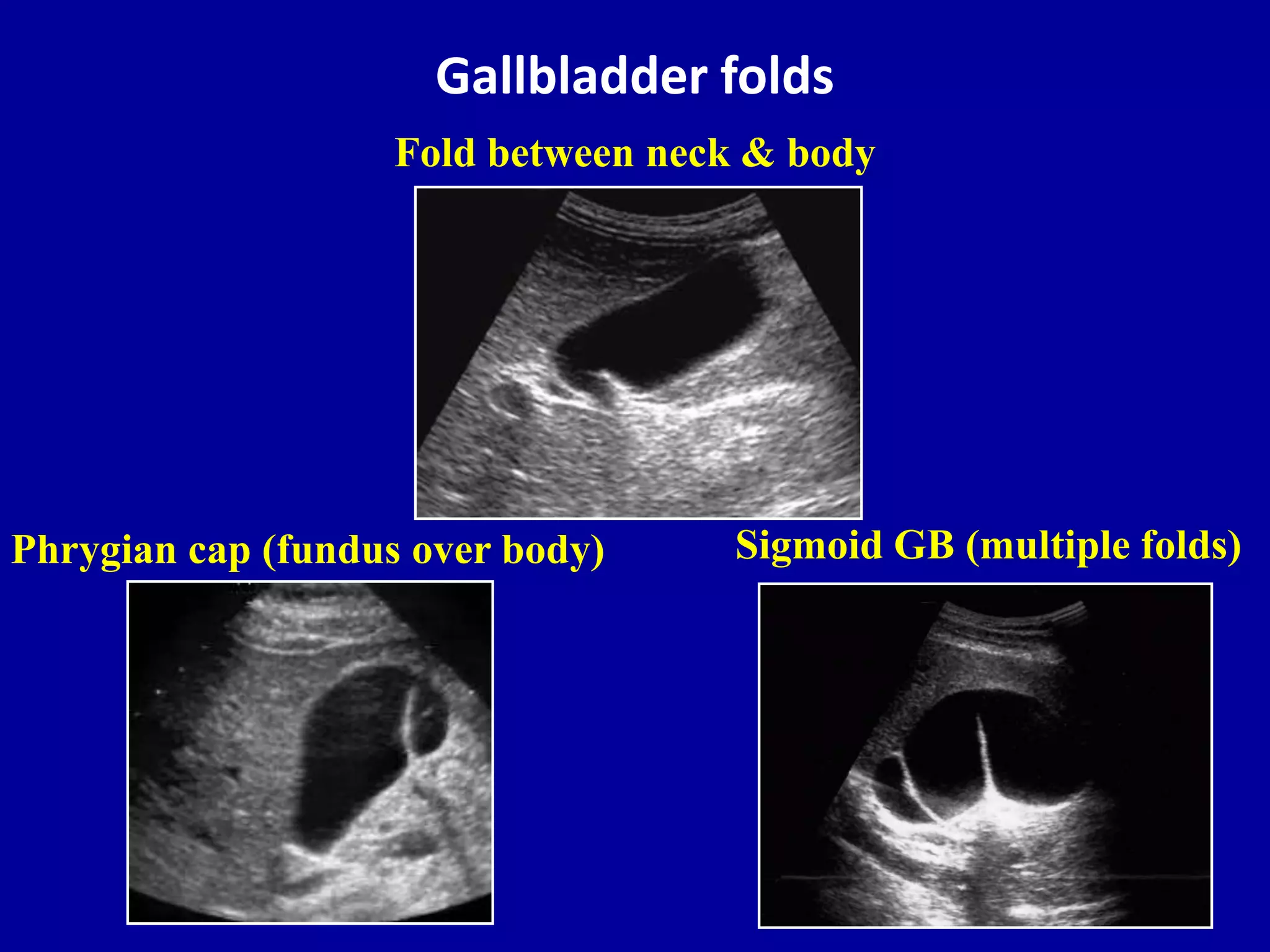 Ultrasound of the gallbladder | PPTX