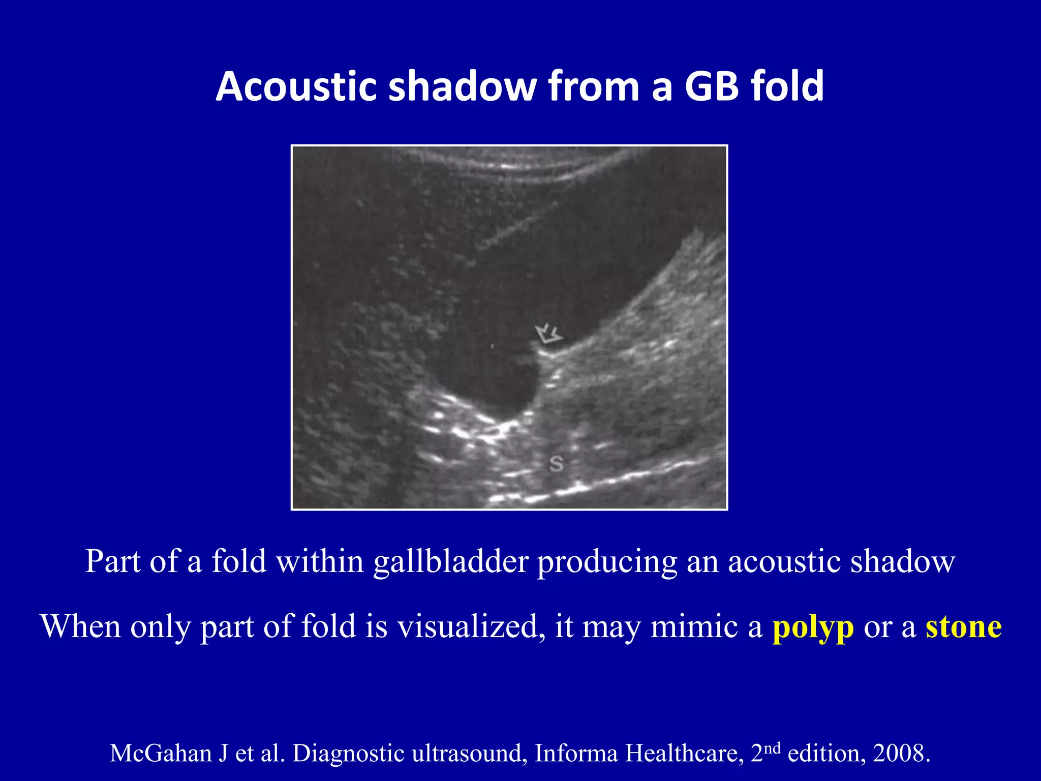 Ultrasound of the gallbladder | PPTX