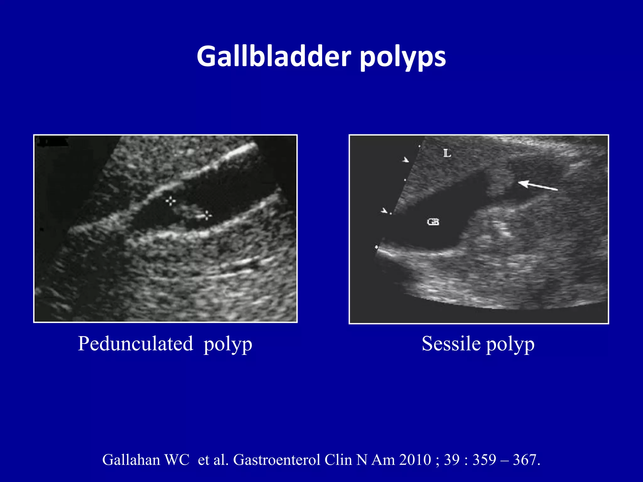 Ultrasound of the gallbladder | PPTX