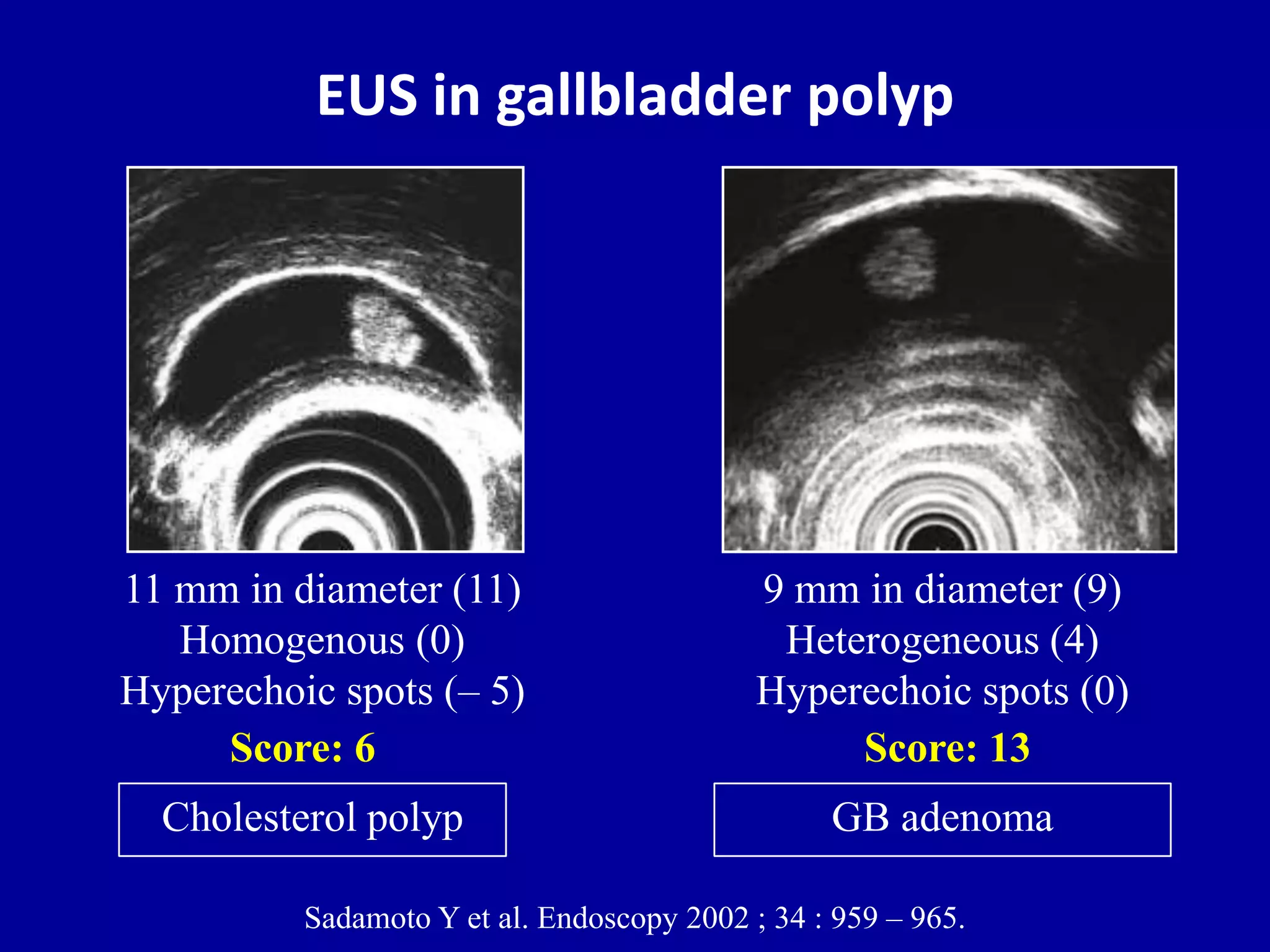 Ultrasound of the gallbladder | PPTX