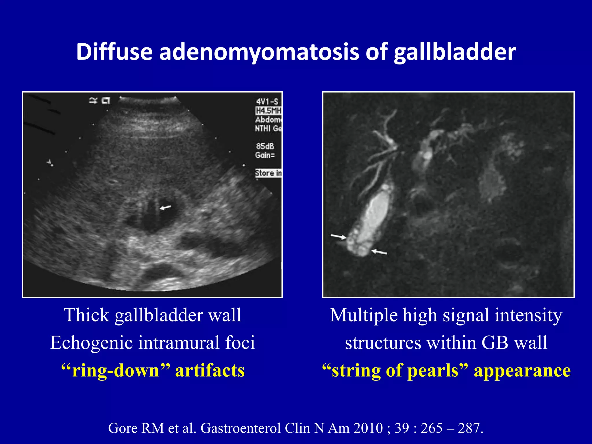 Ultrasound of the gallbladder | PPTX