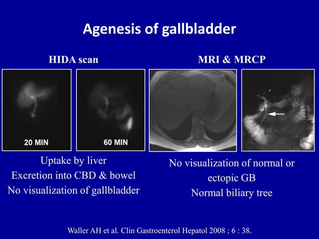 Ultrasound of the gallbladder | PPTX | Digestive Disorders | Diseases ...