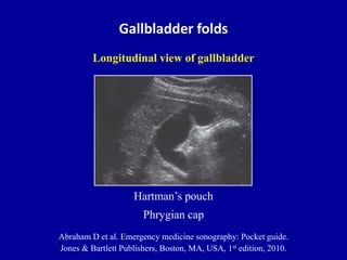Ultrasound of the gallbladder | PPTX