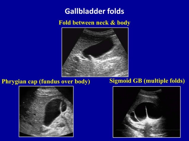 Ultrasound of the gallbladder | PPTX | Digestive Disorders | Diseases ...