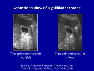 Gallbladder Stone Ultrasound