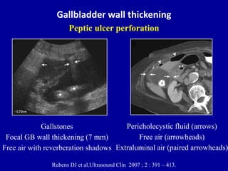 Perforated Gallbladder Ultrasound