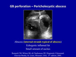 Perforated Gallbladder Ultrasound