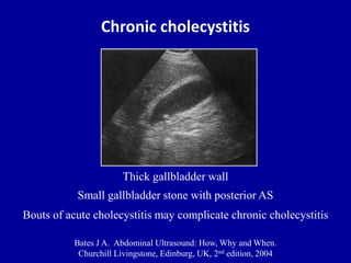 Chronic Cholecystitis Ultrasound Wes Sign