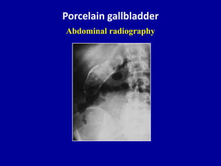 Pigment Gallstones Xray