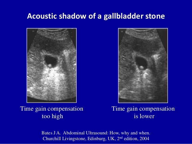 Ultrasound of the gallbladder