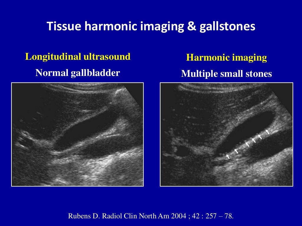 Ultrasound of the gallbladder