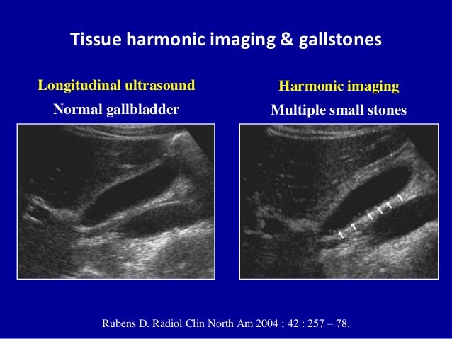 Ultrasound of the gallbladder