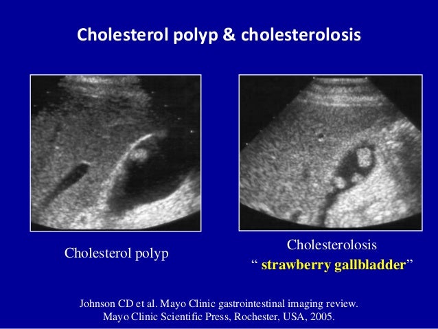 Ultrasound of the gallbladder