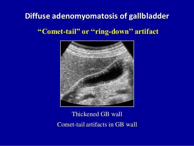 Ultrasound of the gallbladder