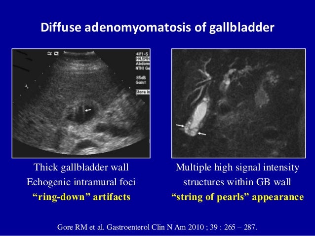 Ultrasound of the gallbladder
