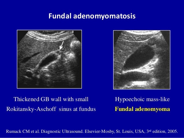 Ultrasound of the gallbladder