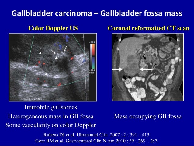Ultrasound of the gallbladder