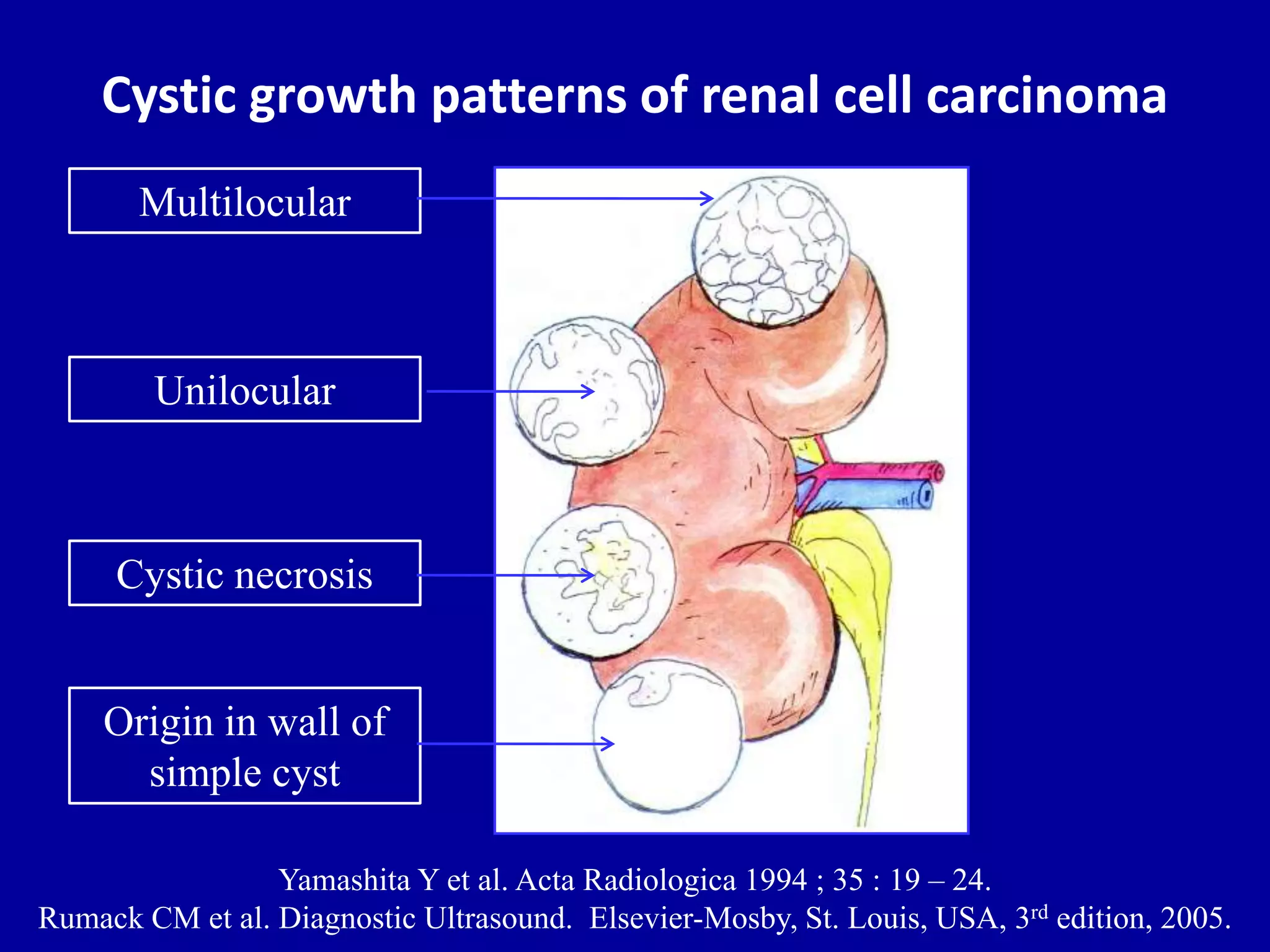 Ultrasound of the urinary tract - Renal cysts | PPTX