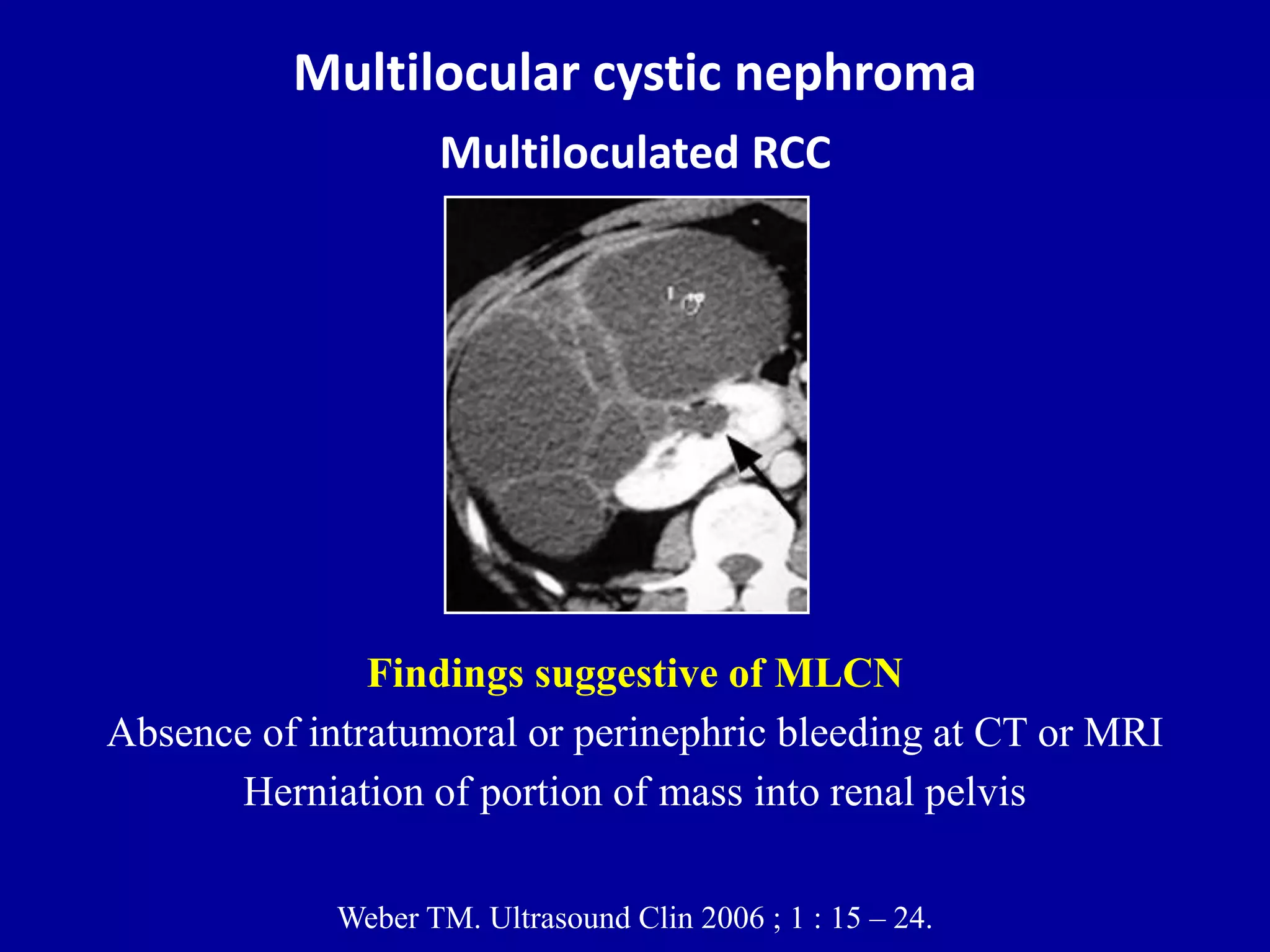 Ultrasound of the urinary tract - Renal cysts | PPTX