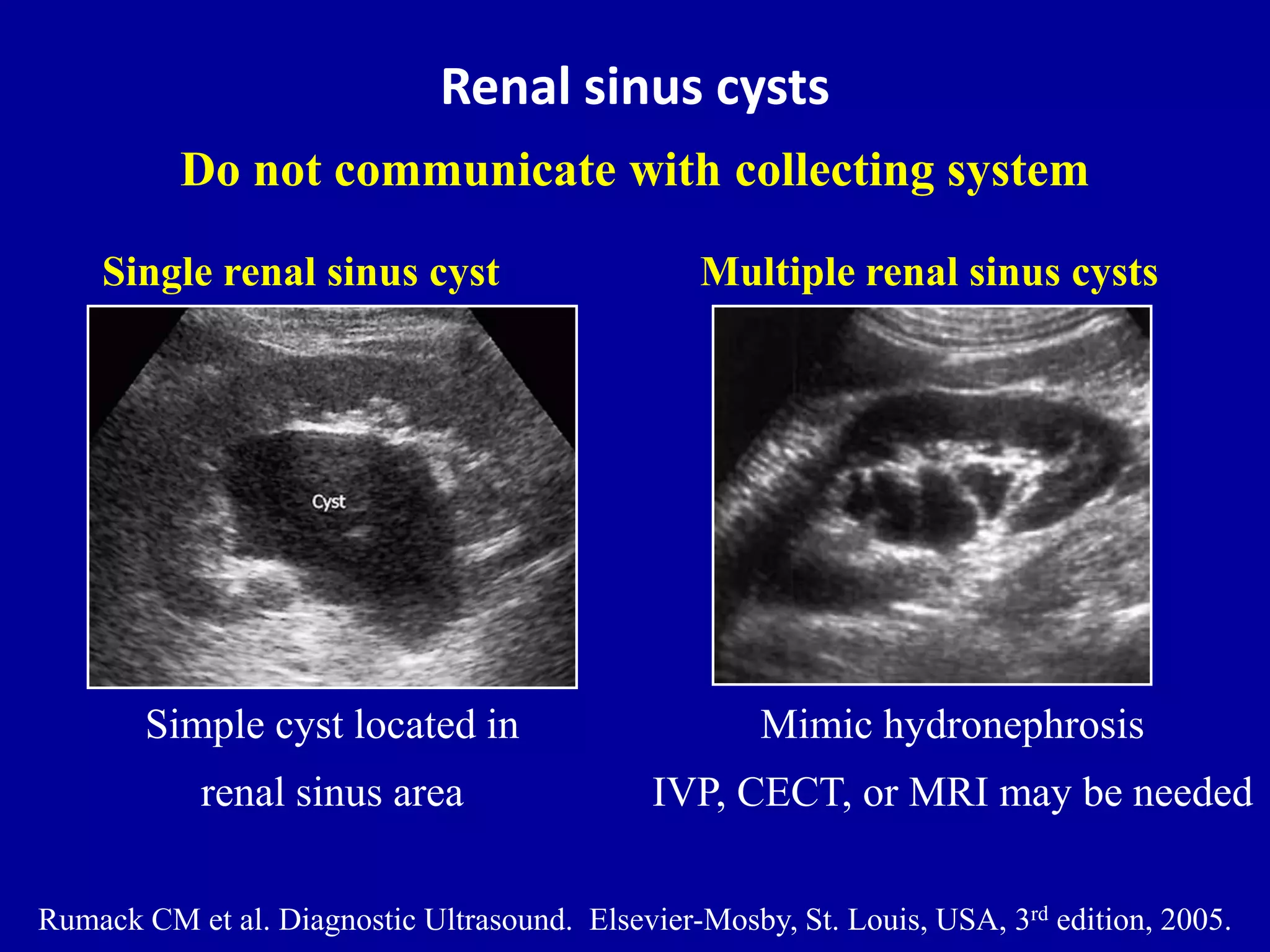 Ultrasound of the urinary tract - Renal cysts | PPTX