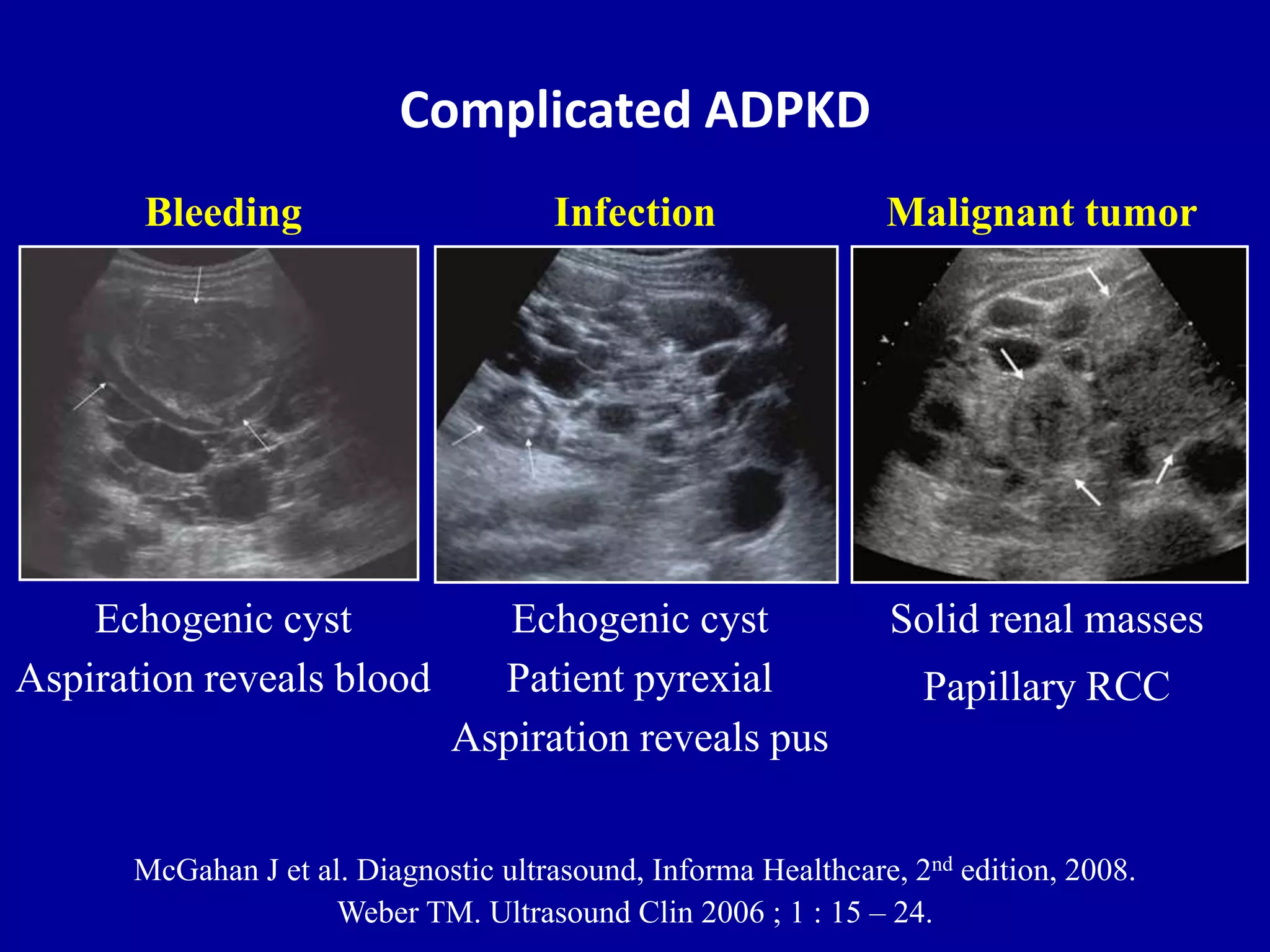 Ultrasound of the urinary tract - Renal cysts | PPTX