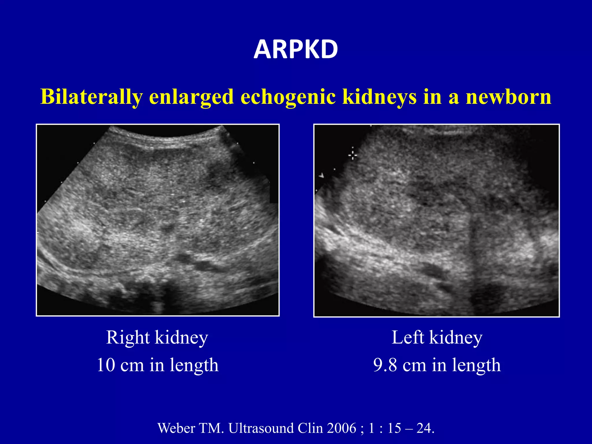 Ultrasound of the urinary tract - Renal cysts | PPTX