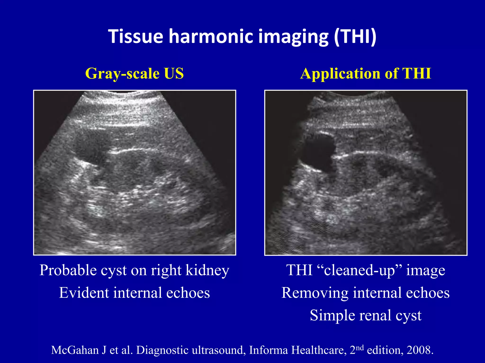 Ultrasound of the urinary tract - Renal cysts | PPTX