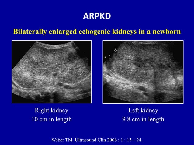 Ultrasound of the urinary tract - Renal cysts | PPTX | Medical Health