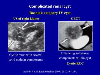 Kidney Cyst Ultrasound And Biopsy Procedure