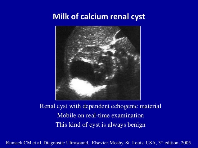 Milk of calcium renal cyst | Ultrasound, Renal, Ultrasound sonography