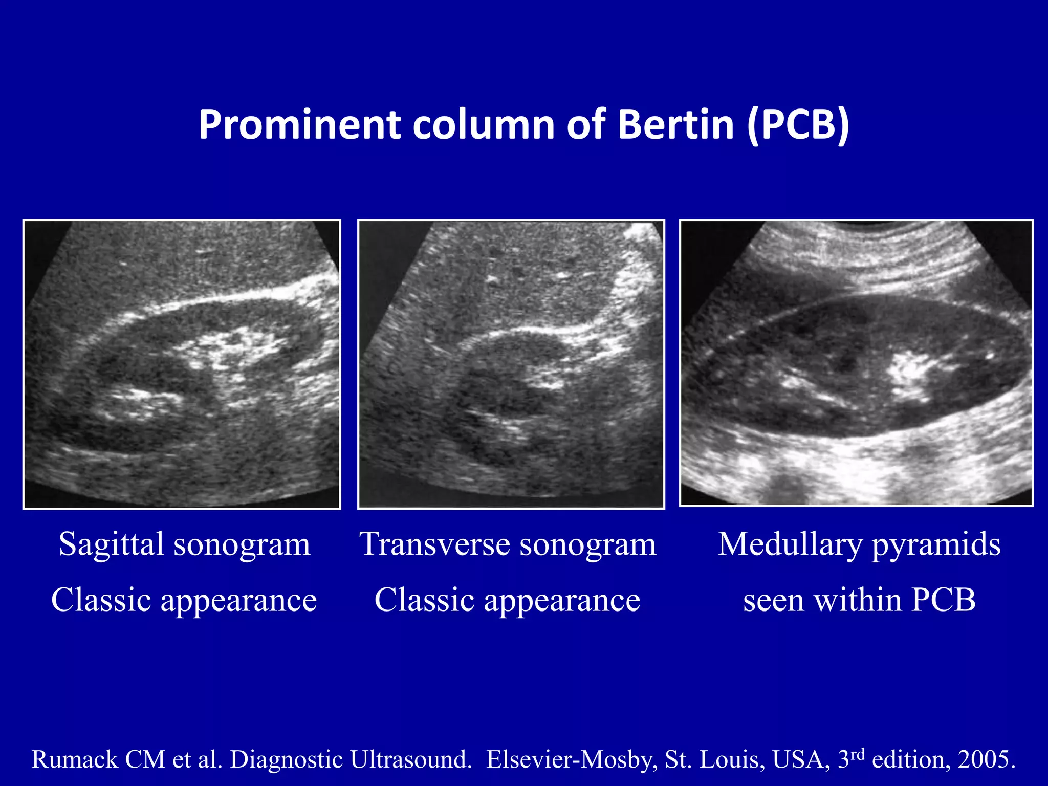 Ultrasound of the urinary tract - Renal tumors | PPTX