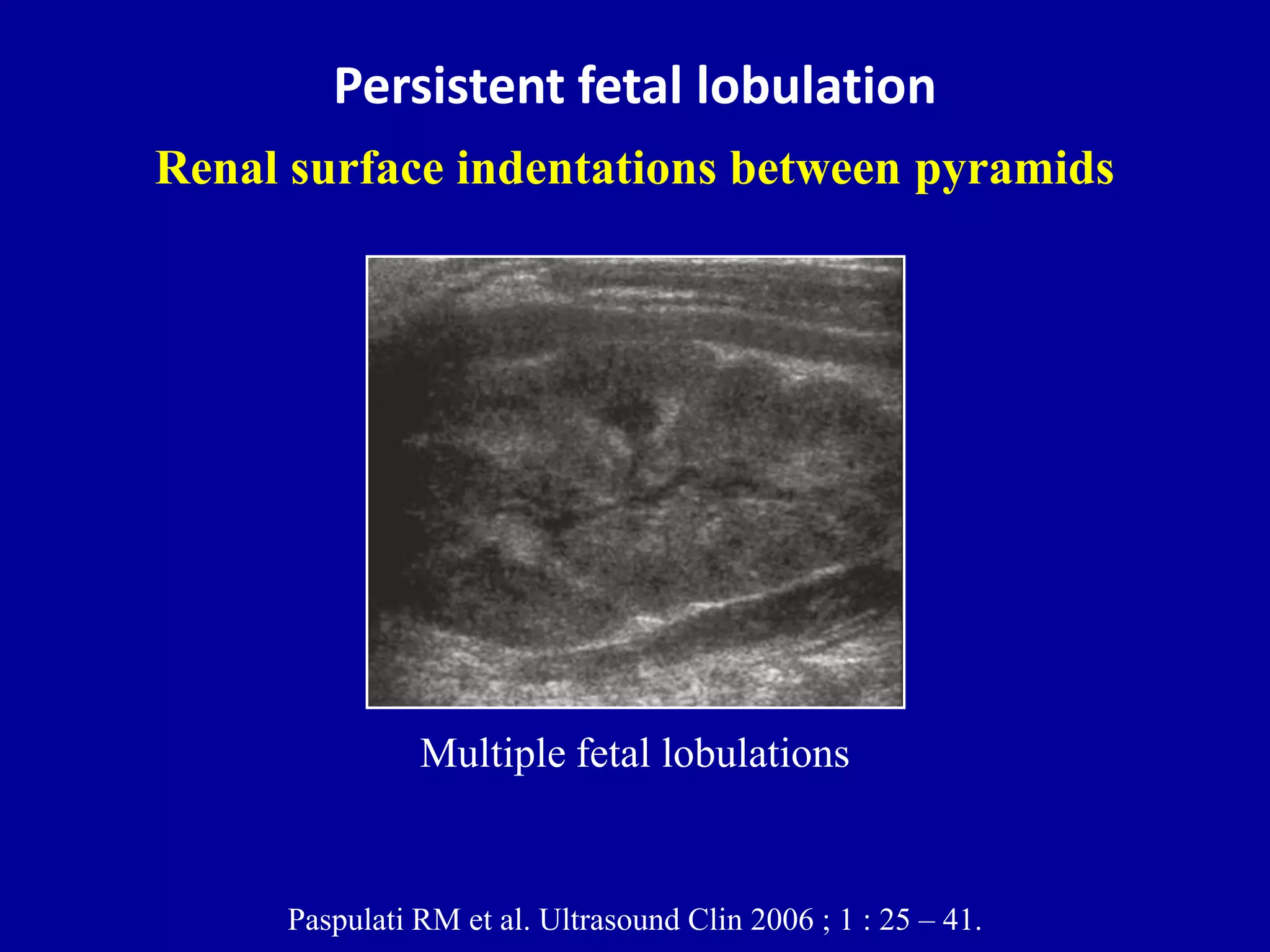 Ultrasound of the urinary tract - Renal tumors | PPTX