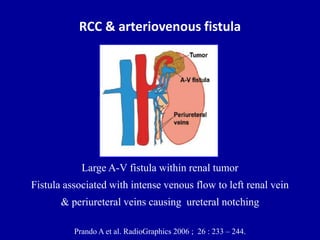 Ultrasound of the urinary tract - Renal tumors | PPTX