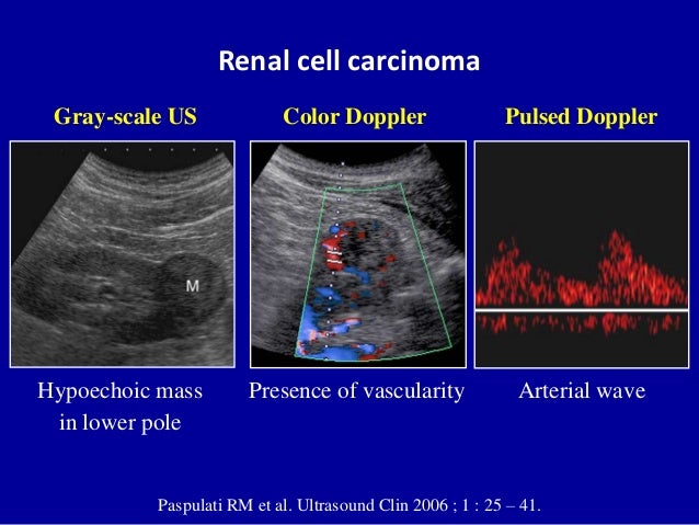Ultrasound of the urinary tract - Renal tumors