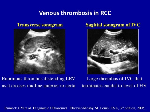 Ultrasound of the urinary tract - Renal tumors