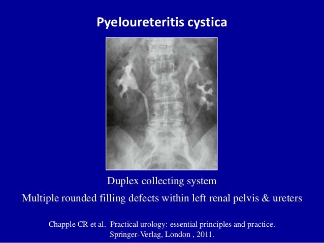 Ultrasound of the urinary tract - Renal tumors