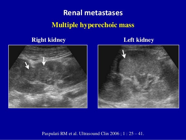 Ultrasound of the urinary tract - Renal tumors