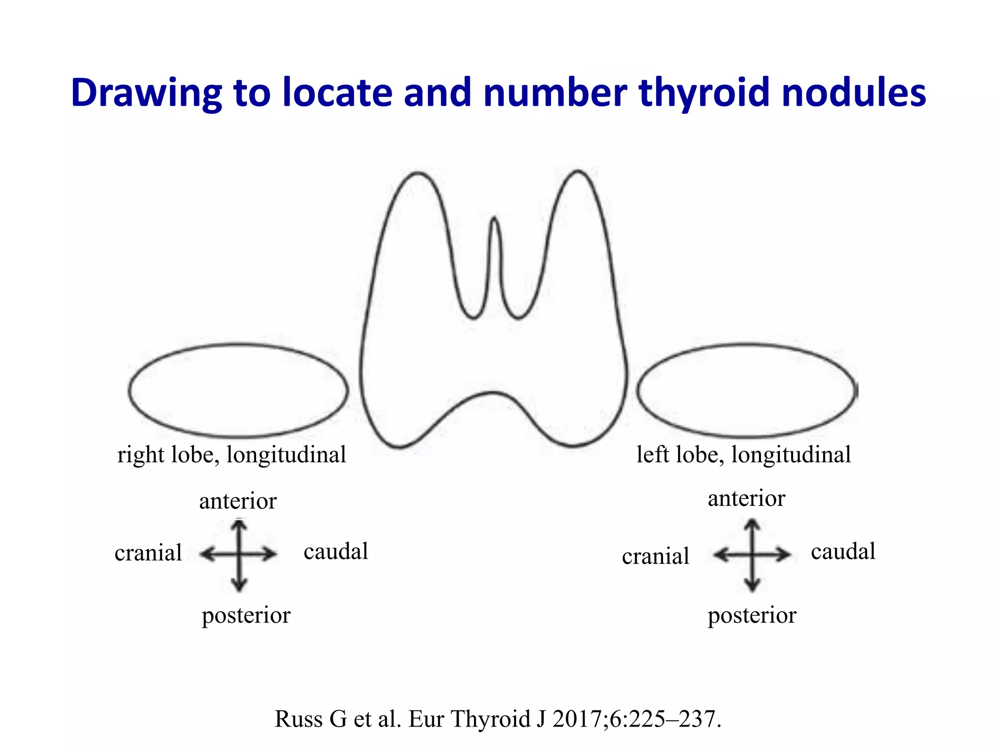 Ultrasound Of Thyroid Nodules Ppt