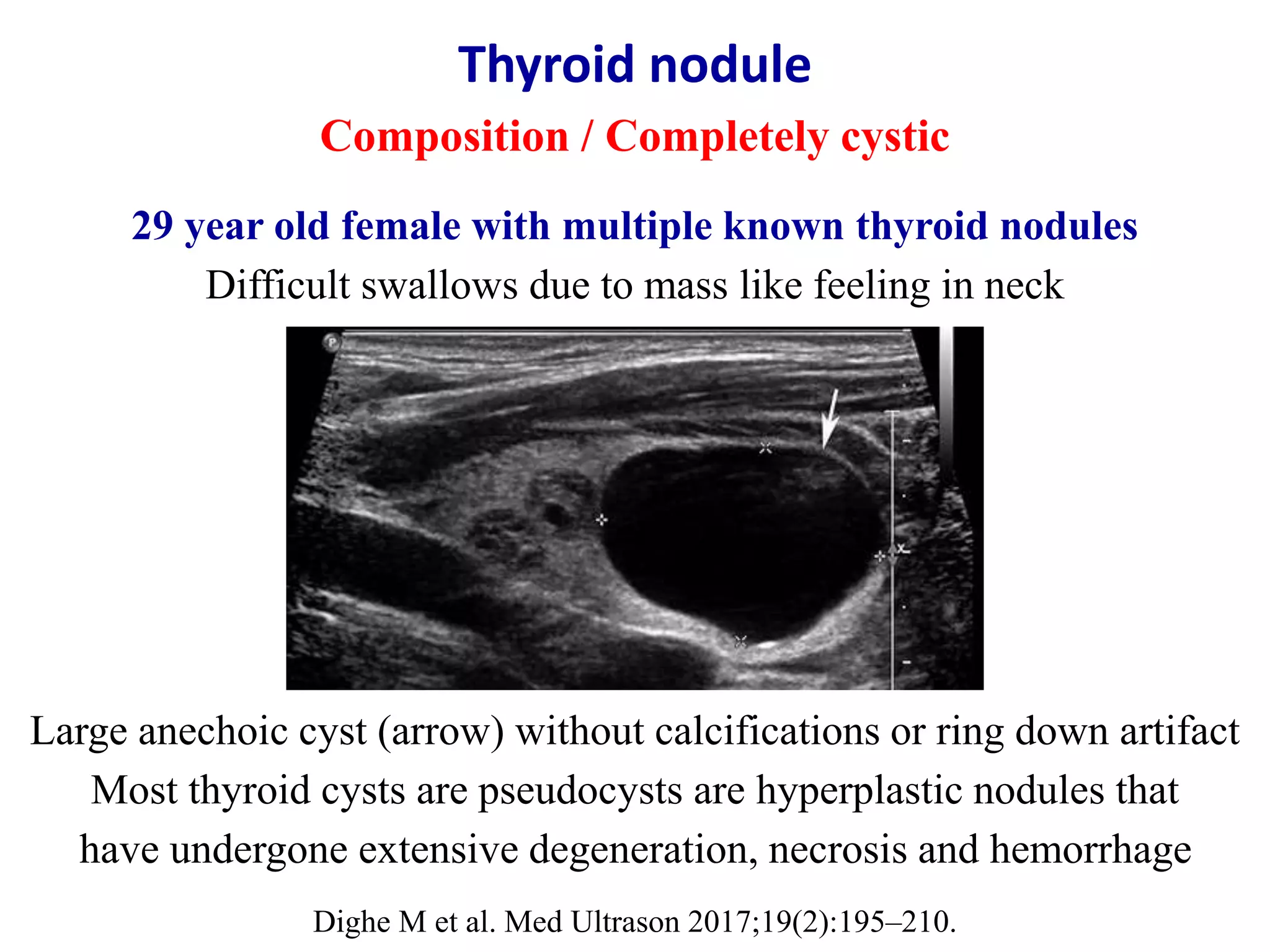 Ultrasound of thyroid nodules | PPTX