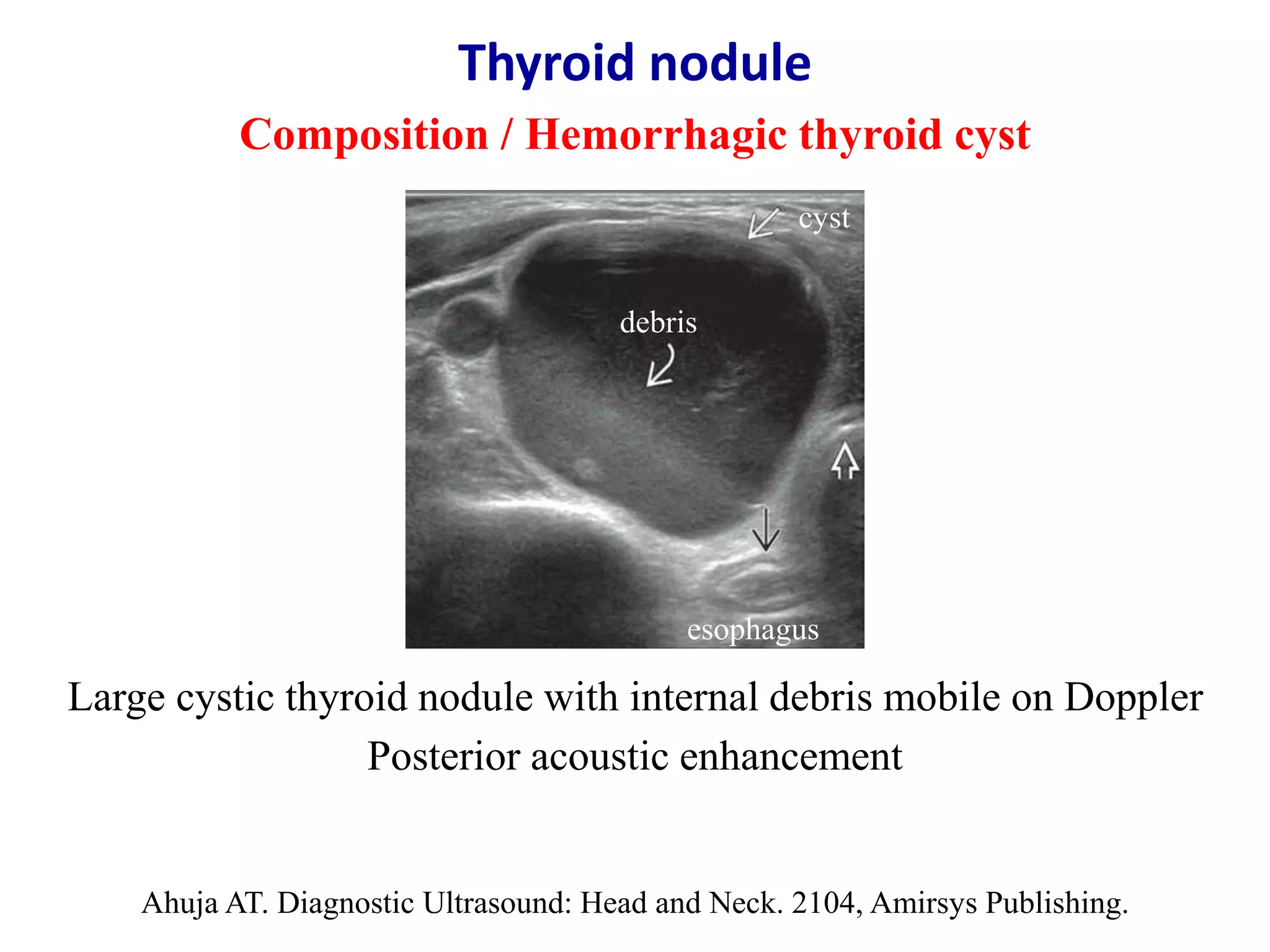 Ultrasound of thyroid nodules | PPTX