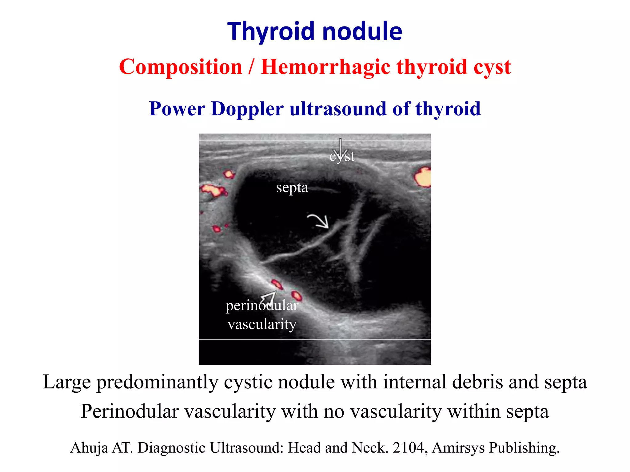 Ultrasound of thyroid nodules | PPTX